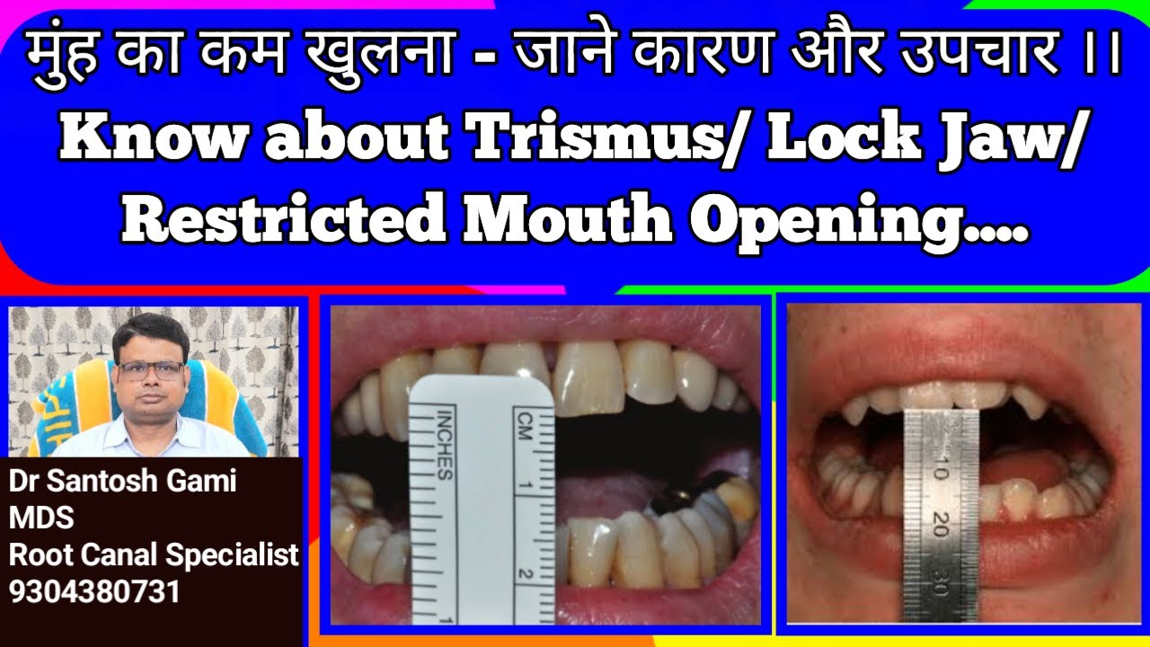 मुंह का कम खुलना - जाने कारण और उपचार ।। Know about Trismus/ Lock Jaw ...
