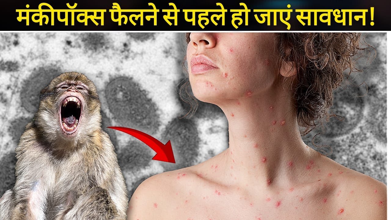 Monkeypox Virus in Hindi | Monkeypox Virus Outbreak | Monkeypox Explain in Hindi - YouTube