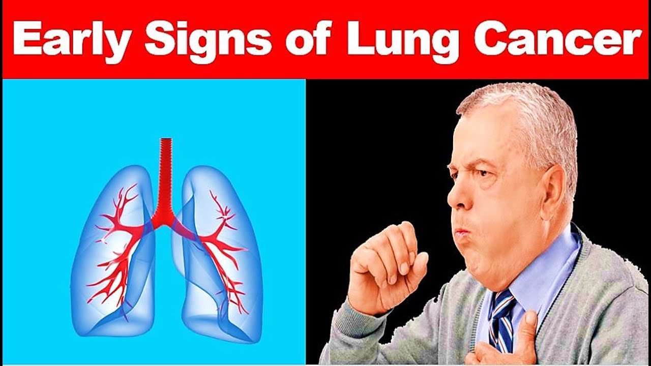 Early Warning Signs of Lung Cancer: Recognize Red the Flags - YouTube