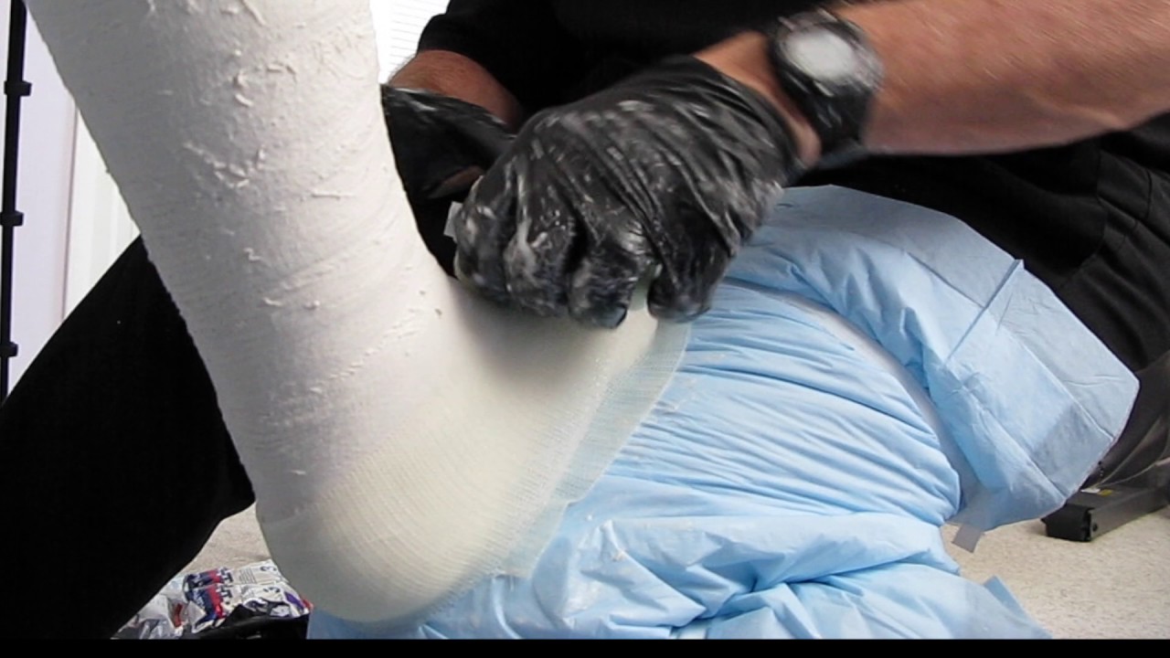 Total Contact Cast - YouTube