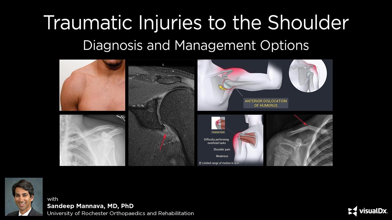 Traumatic Injuries to the Shoulder: Diagnosis and Management Options ...