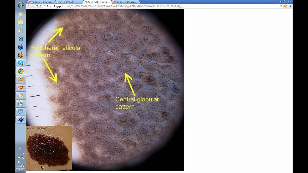 Dermoscopy Made Simple - Congenital nevus - YouTube