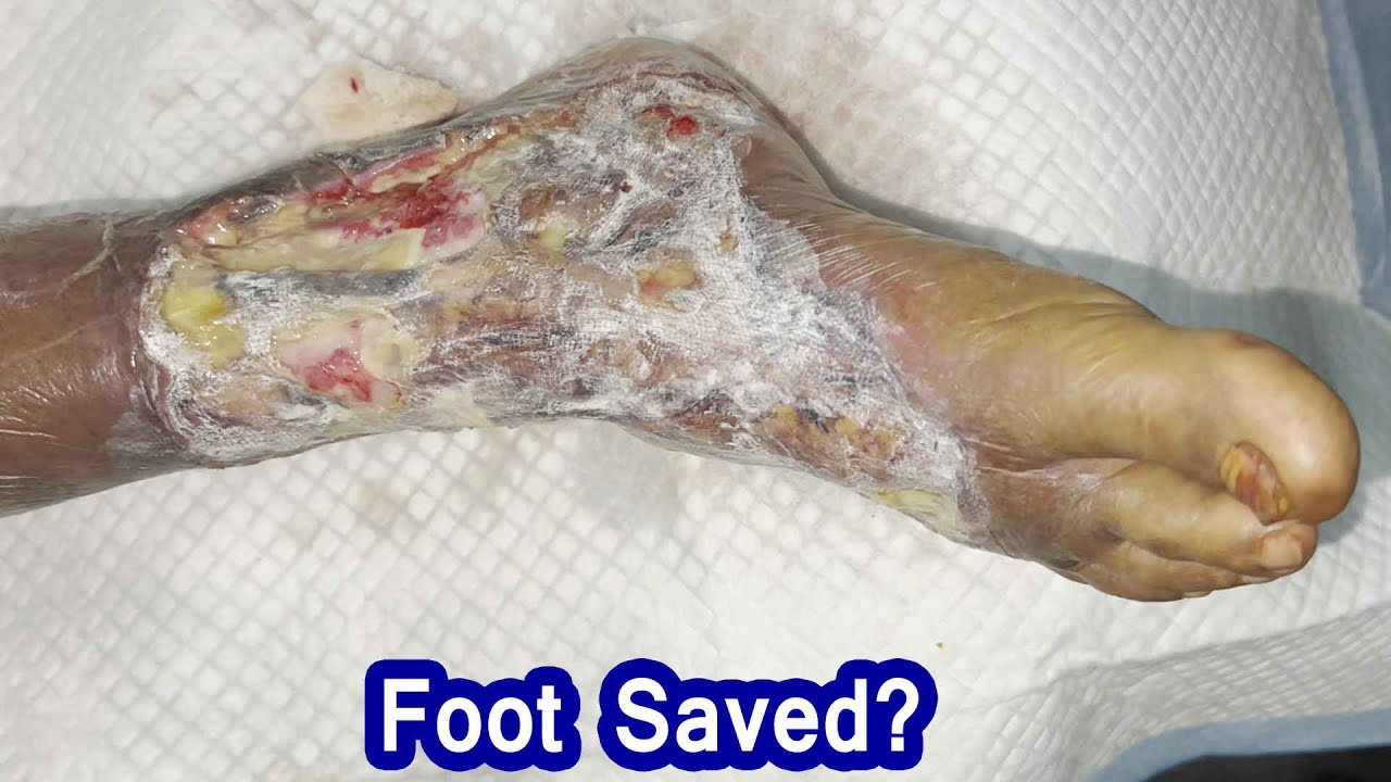 #cellulitis #infection | Necrotizing Fascitis Healing Stages - YouTube