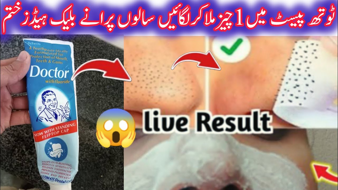 How To Remove BLACKHEADS At Home In Just 5 Mints Best Way To Remove how-to-remove-blackheads-at-home-in-just-5-mints-best-way-to-remove