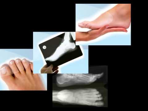 How to Tape a Hammer Toe - YouTube