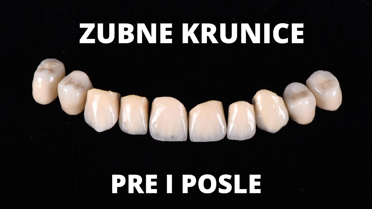 Zubne krunice boja A2 - YouTube