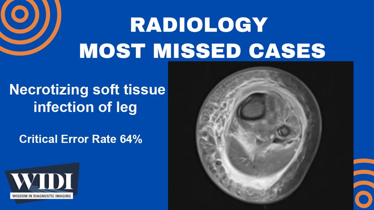 Most Missed Cases: Necrotizing soft tissue infection of leg - YouTube