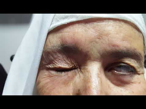 signe de charles bell - YouTube