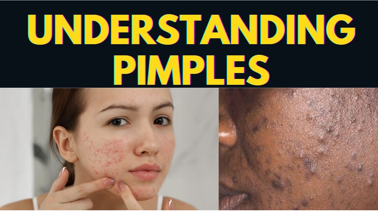 PIMPLES || All you need to know about them - YouTube