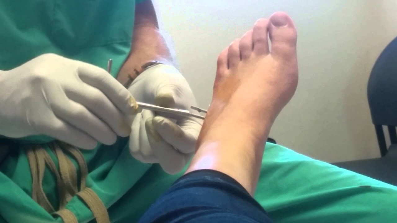 Removal of Jones Fracture X fix (External Fixation Device) - YouTube