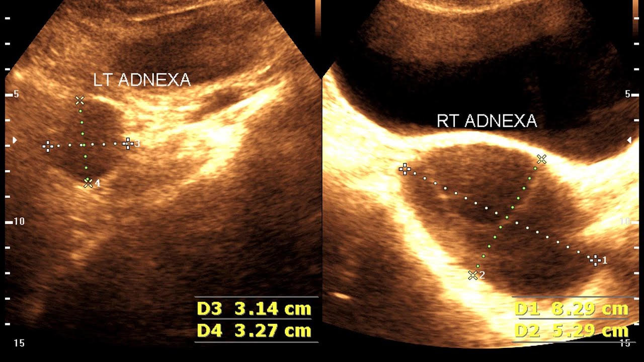 Ultrasound cases 162 of 2000 || Multiloculated Ovarian cyst - YouTube