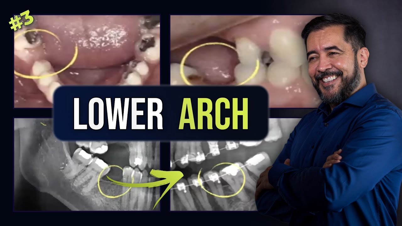 Closing remaining space in Lower Arch #3 | ORTHODONTIC TIPS - YouTube