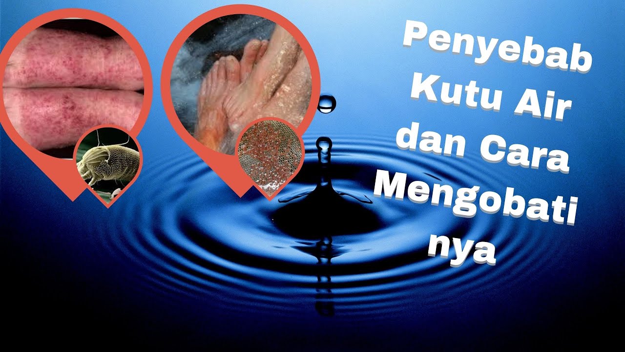 Penyebab Kutu Air dan Cara Mengobatinya - YouTube
