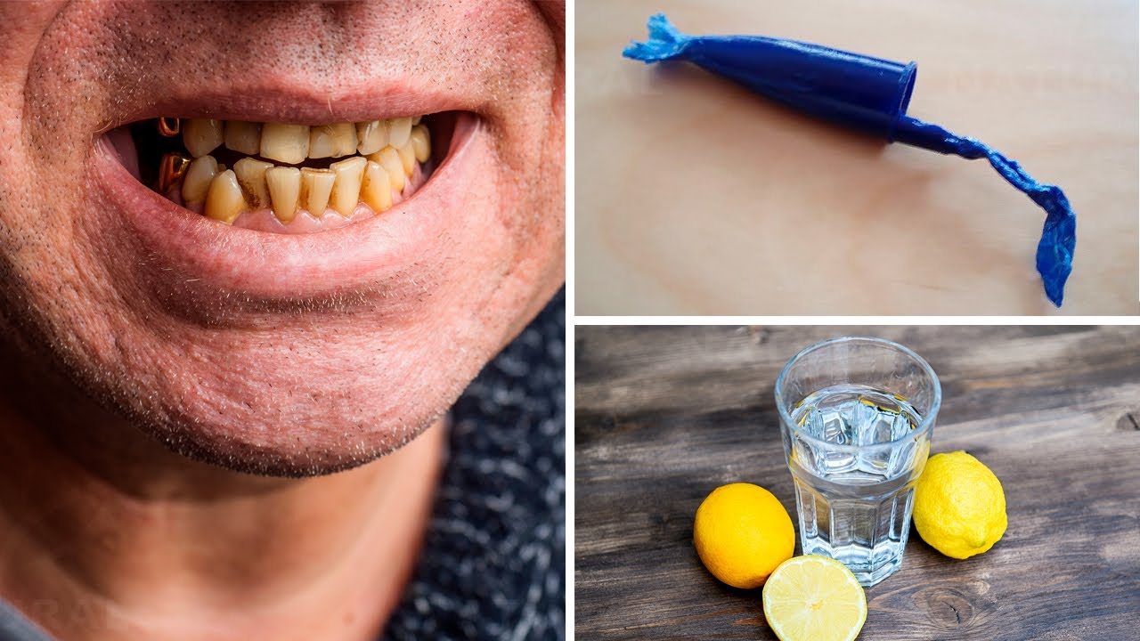 5 Bad Habits That Can Damage Your Smile YouTube 5-bad-habits-that-can-damage-your-smile-youtube