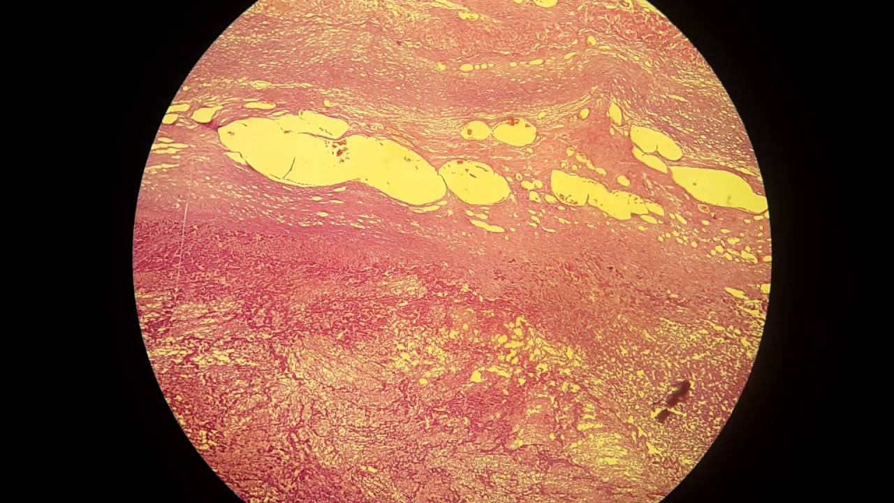 Coagulative necrosis ( MI ) - YouTube