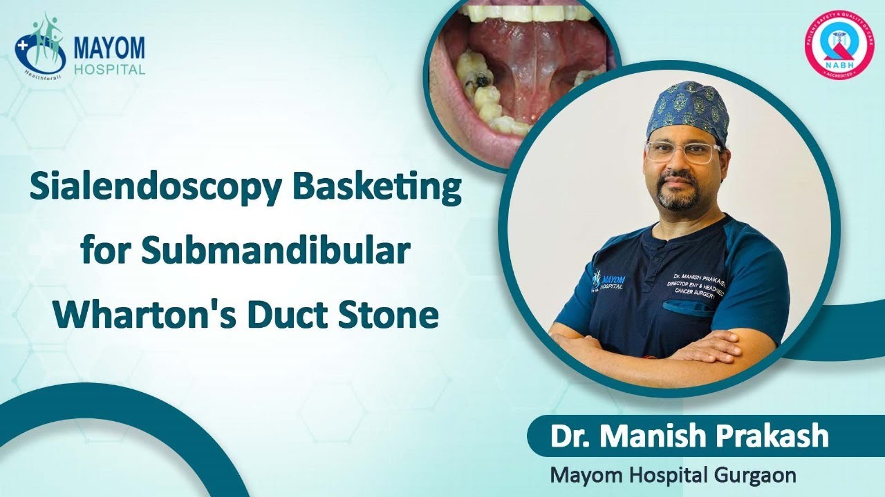 Sialendoscopy Basketing for Submandibular Whartons Duct Stone by Dr ...