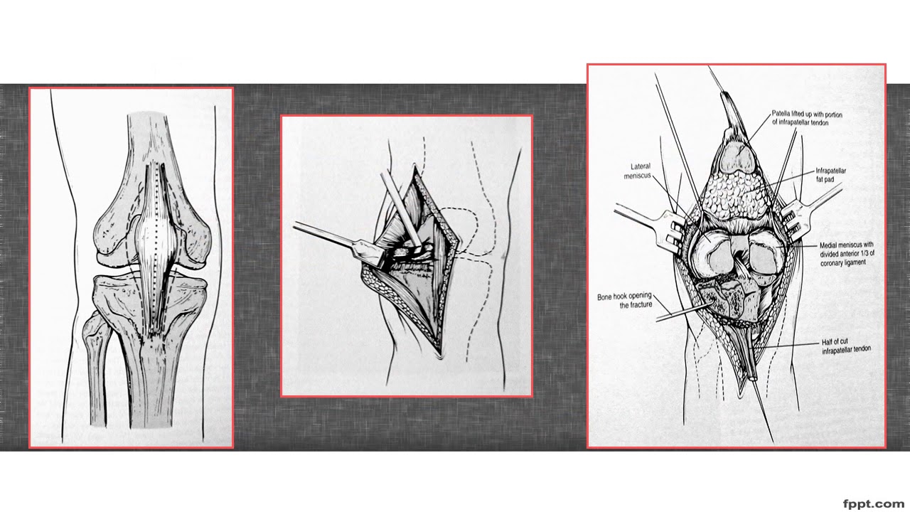 FRACTURAS DE PLATILLO TIBIAL - YouTube