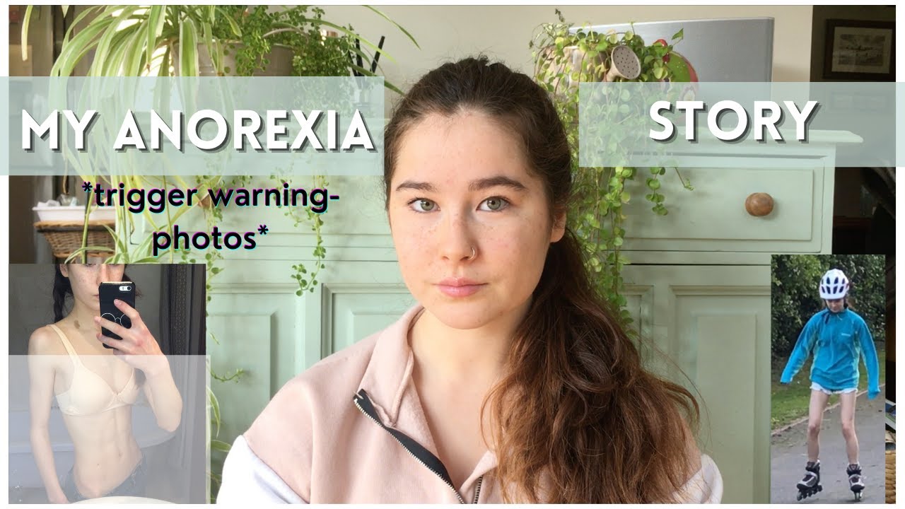 My Anorexia Story | Eating Disorder Story with photos (trigger warning ...