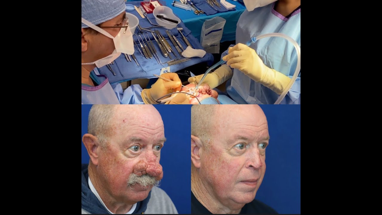 Rhinophyma correction with excision and laser!Inose job before &after ...