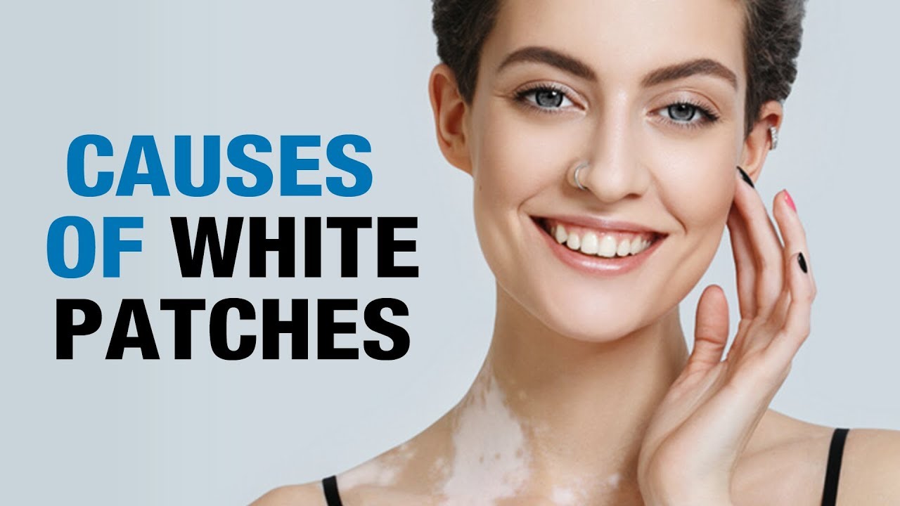 Causes Of White Patches - Dr. Nitika Kohli - AIMIL - YouTube