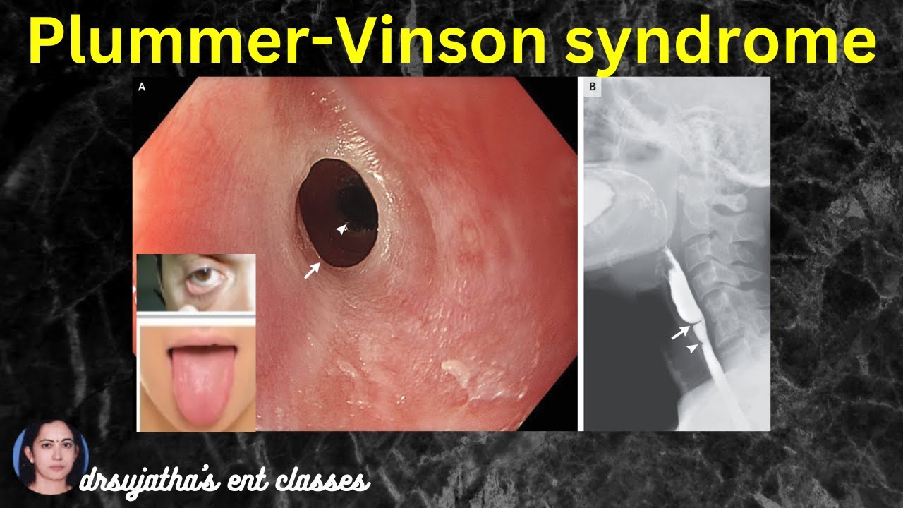 260.Plummer-Vinson syndrome : Paterson-Brown-Kelly syndrome /syndromes ...