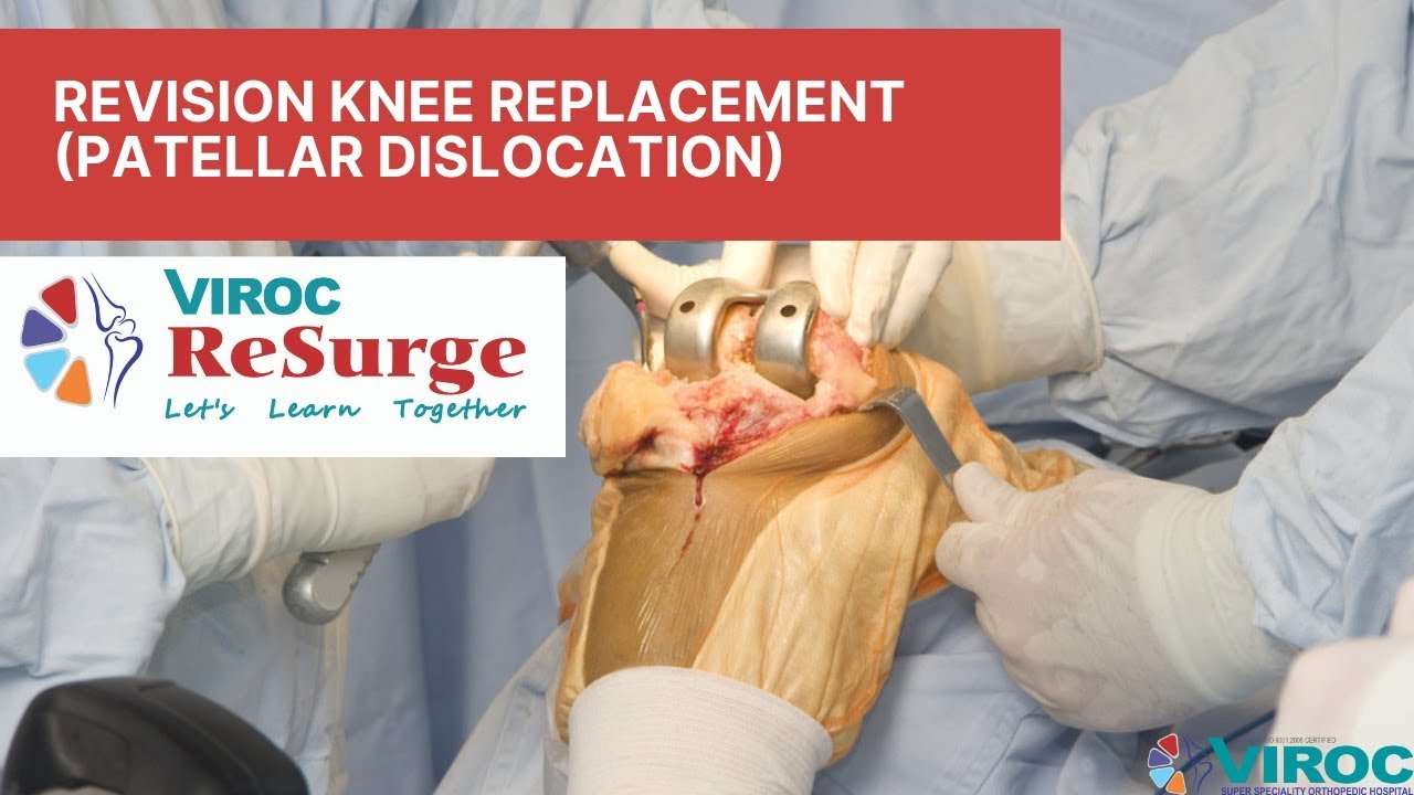 Revision Knee Replacement (Case of Patella Dislocation) - YouTube
