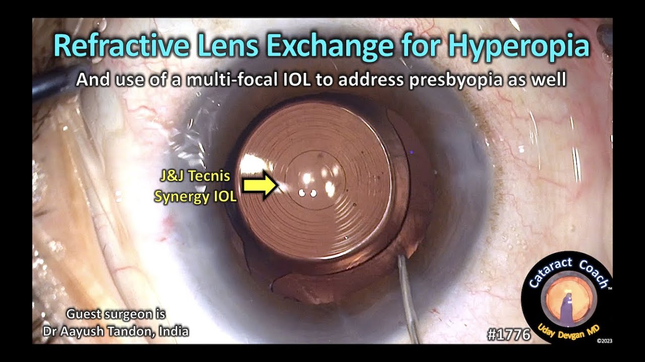CataractCoach™1776: refractive lens exchange for hyperopia with Tecnis ...