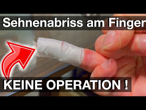 Sehnenabriss am Finger (wie heilen wir das???) - YouTube