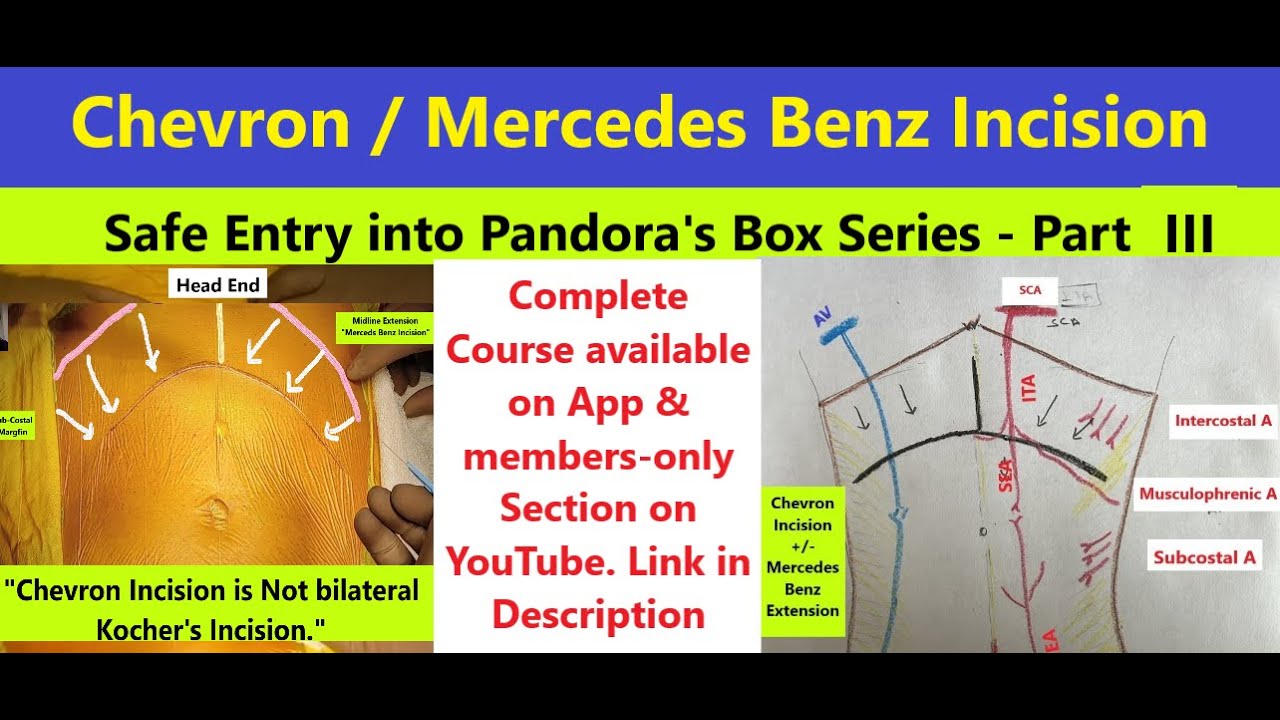 Vid 2.1 (Old) - Chevron / Mercedes Benz Incision - Entry into Pandora ...