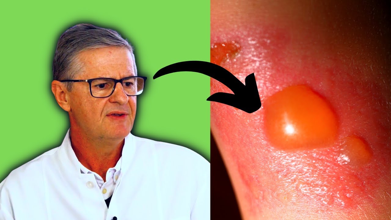 BOLHAS (flictenas) na pele APÓS CIRURGIA - Reality da Ortopedia #09 ...