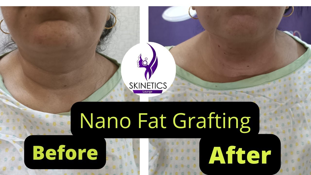 Nano Fat Removal Before and After | What is Nano fat grafting? | Fat ...