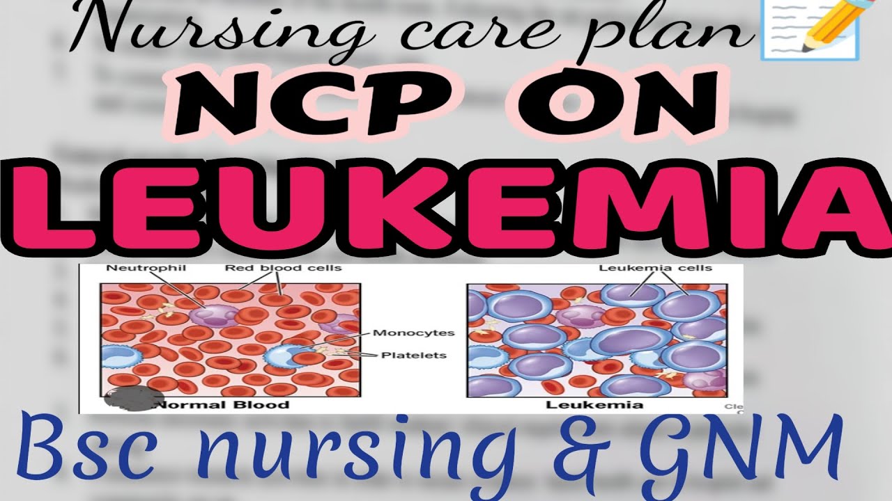 Ncp on LEUKEMIA ||medical surgical nursing||child health nursing||Bsc ...
