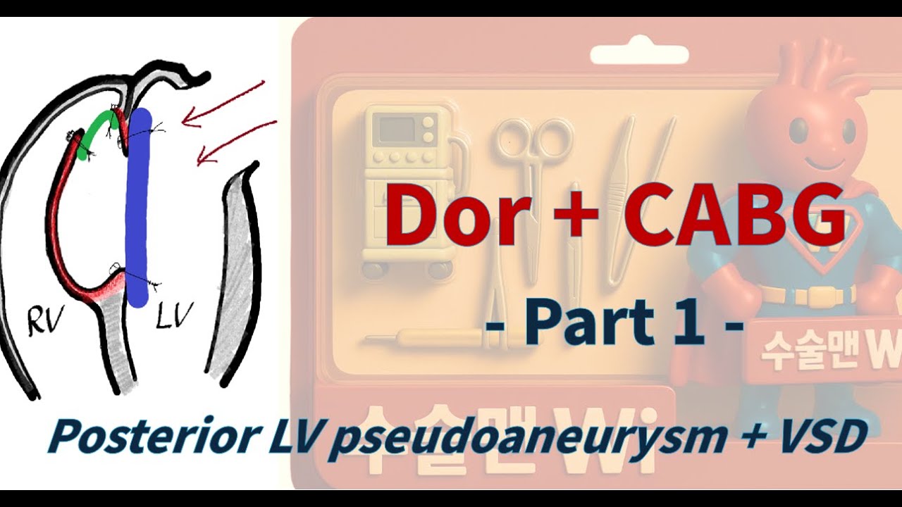 1. Modified Dor's procedure /c CABG (posterior LV pseudoaneurysm + VSD ...