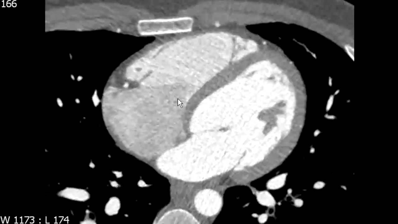 Right Atrial Anatomy on Axial Cardiac CTA - YouTube