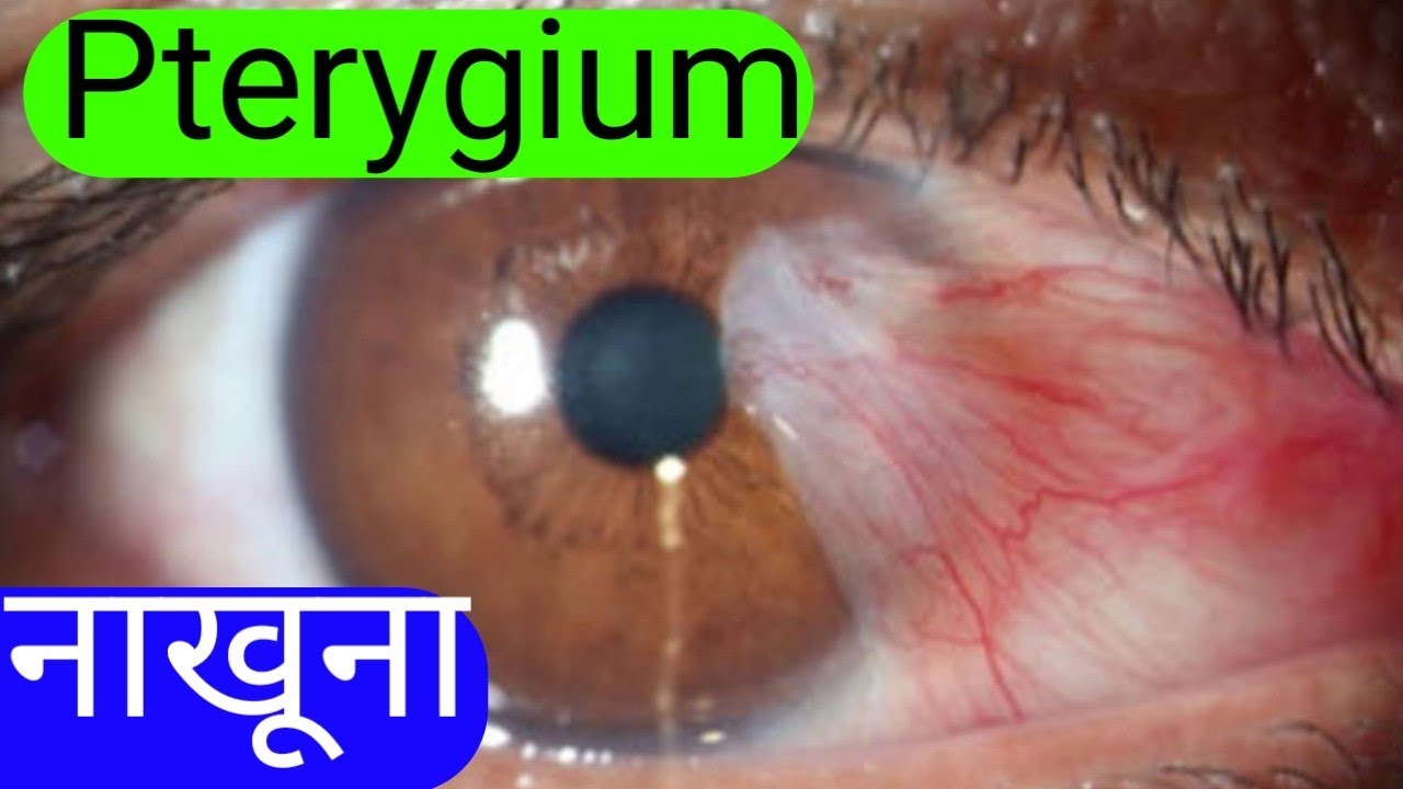 आंख में नखुना का इलाज।aankh me nakhuna ka Ilaj। Pterygium।What is ...