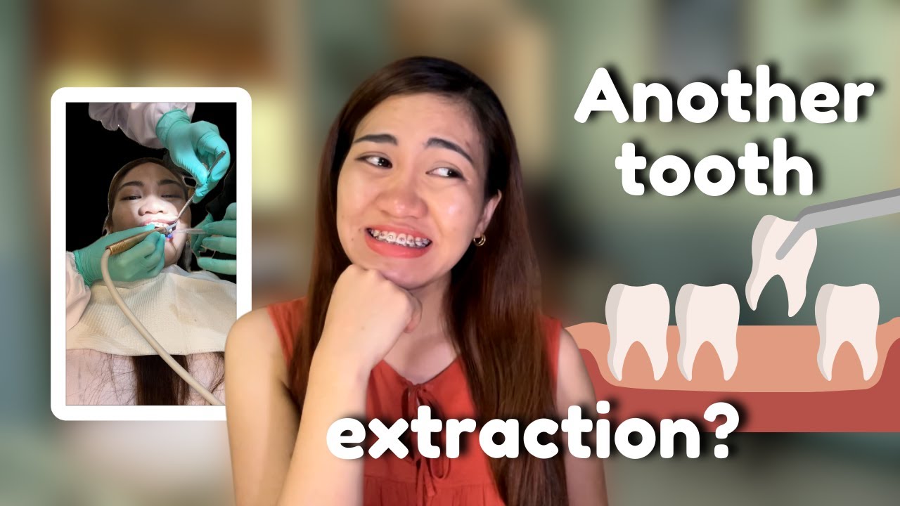 September Braces Update | Tooth extraction | Teeth Gaps | Wires - YouTube