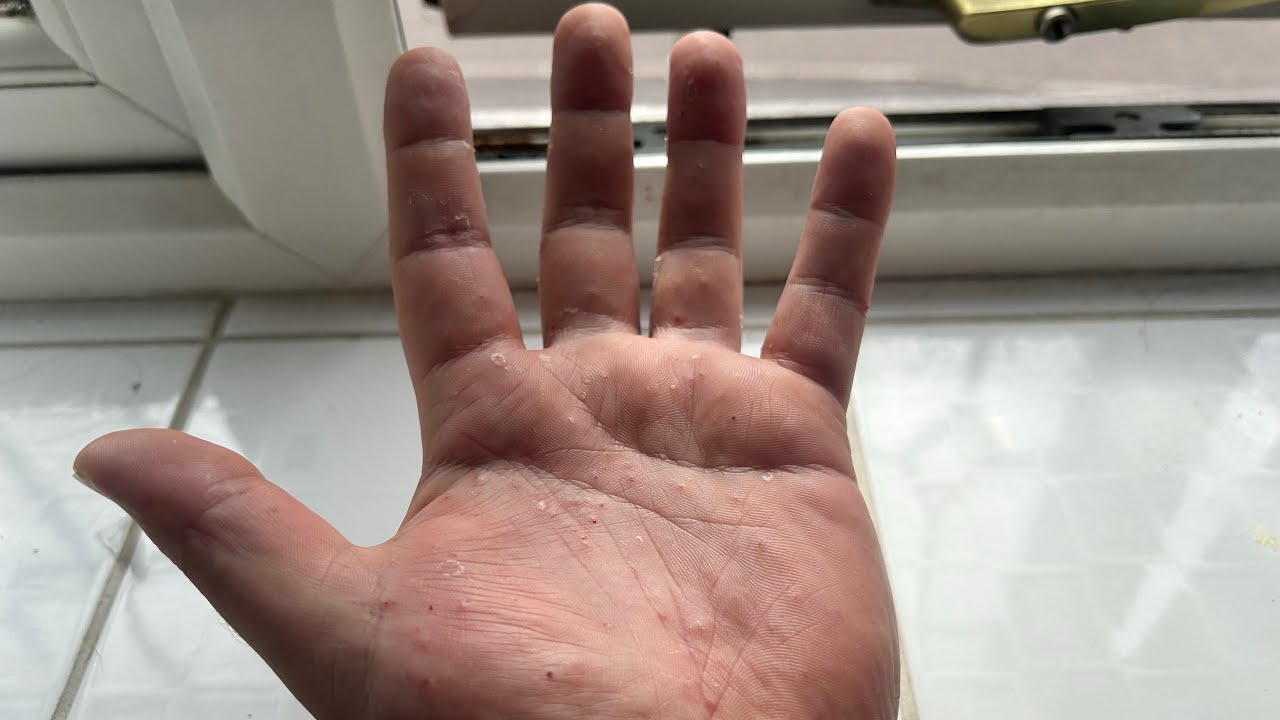 Tarantula Urticating Hairs! Treatment (2024 Revised Edition) - YouTube