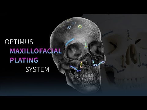 OSTEONIC OMF PLATING SYSTEM - YouTube