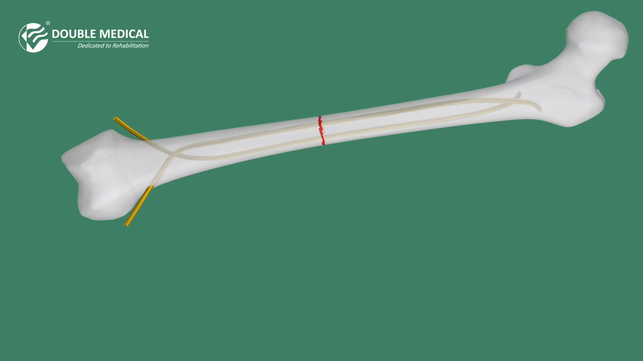 Video Operation of Titanium Elastic Nail - YouTube