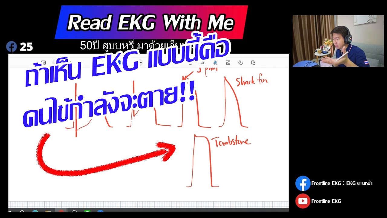 หนึ่งใน Pattern EKG ที่อันตรายที่สุด Shark fin & Tombstone | Frontline ...