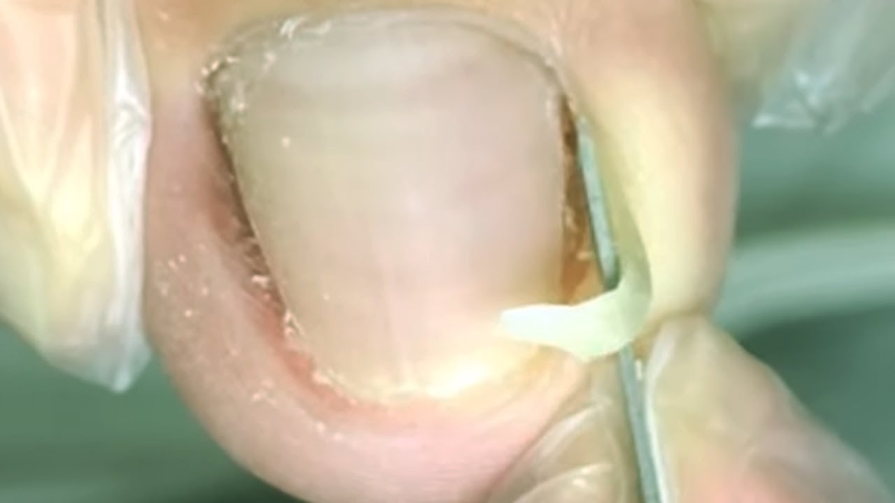 Relaxing Pedicure: Professional Foot Care【 Dr. Zhang】 - YouTube