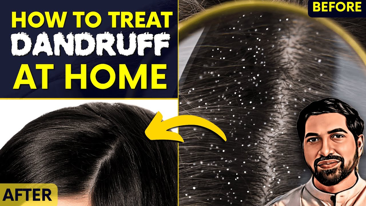Home Remedies For Dandruff | Dandruff Remedies - YouTube