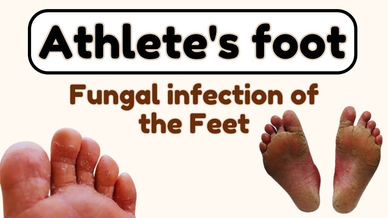 Athlete's foot | Tinea Pedis is the Fungal infection of Feet - YouTube
