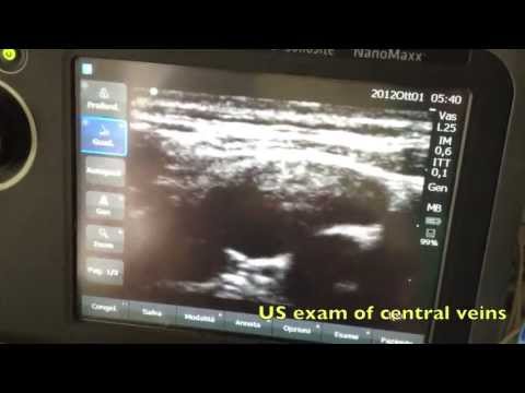 Placement of a post-insertion trimmable PICC line using ECG - YouTube