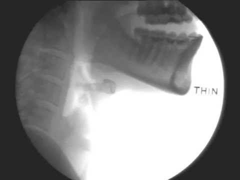 2015 Digital Diagnostic Solutions - Modified Barium Swallow Study - YouTube