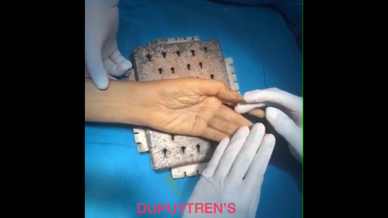 Dupuytren’s Contracture Release & Reconstruction with Full Thickness ...