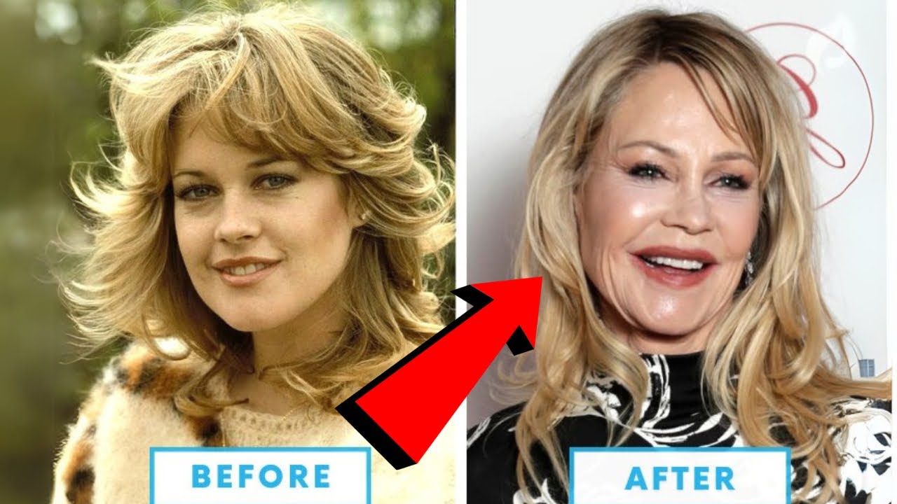 Celebrities With The Worst Botched Plastic Surgery - YouTube