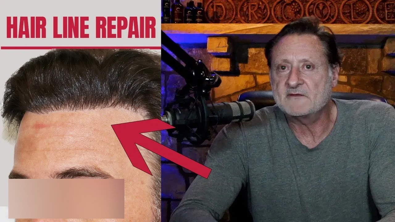 FUE hair Transplant Hairline Repair - Learn How to Avoid! - YouTube