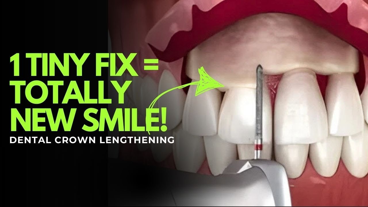 Dental Crown Lengthening Explained | Why & How It’s Done 🦷 - YouTube