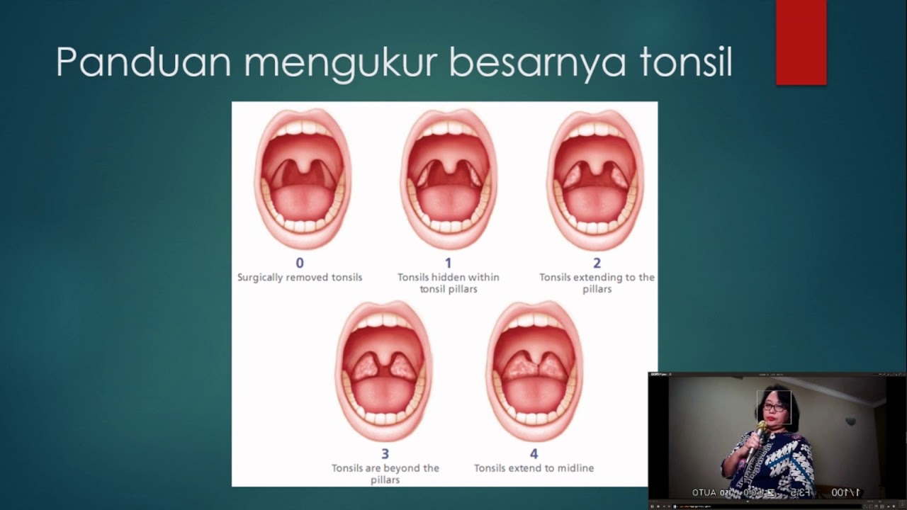 Operasi Amandel Terbaru Modern Di Semarang - YouTube